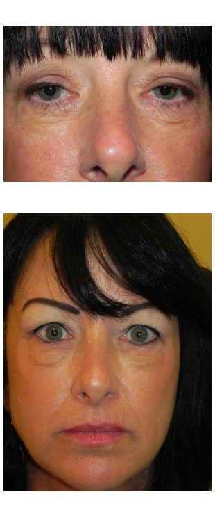 Festoons After Fillers – Adam Scheiner MD | Dr. Adam Scheiner