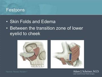 10 Things You NEED to Know About Festoons – Adam Scheiner MD | Dr. Adam ...