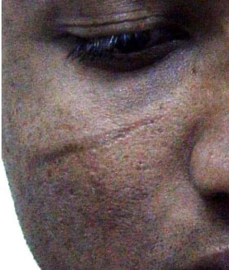 10 Things You NEED to Know About Festoons – Adam Scheiner MD | Dr. Adam ...