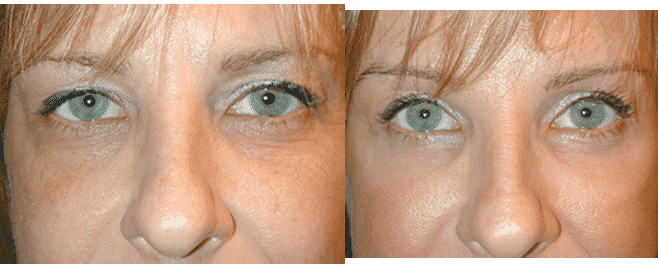 Why Are Lasers Ideal In Eyelid and Facial Rejuvenation – Adam Scheiner ...