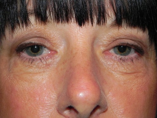 10 Things You NEED to Know About Festoons – Adam Scheiner MD | Dr. Adam ...