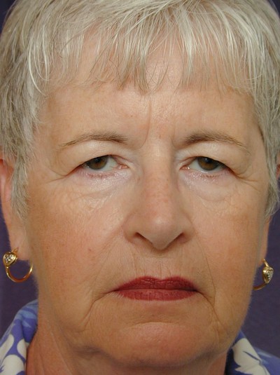 The Deeper Meaning Behind “Bitchy Resting Face” – Adam Scheiner MD | Dr ...