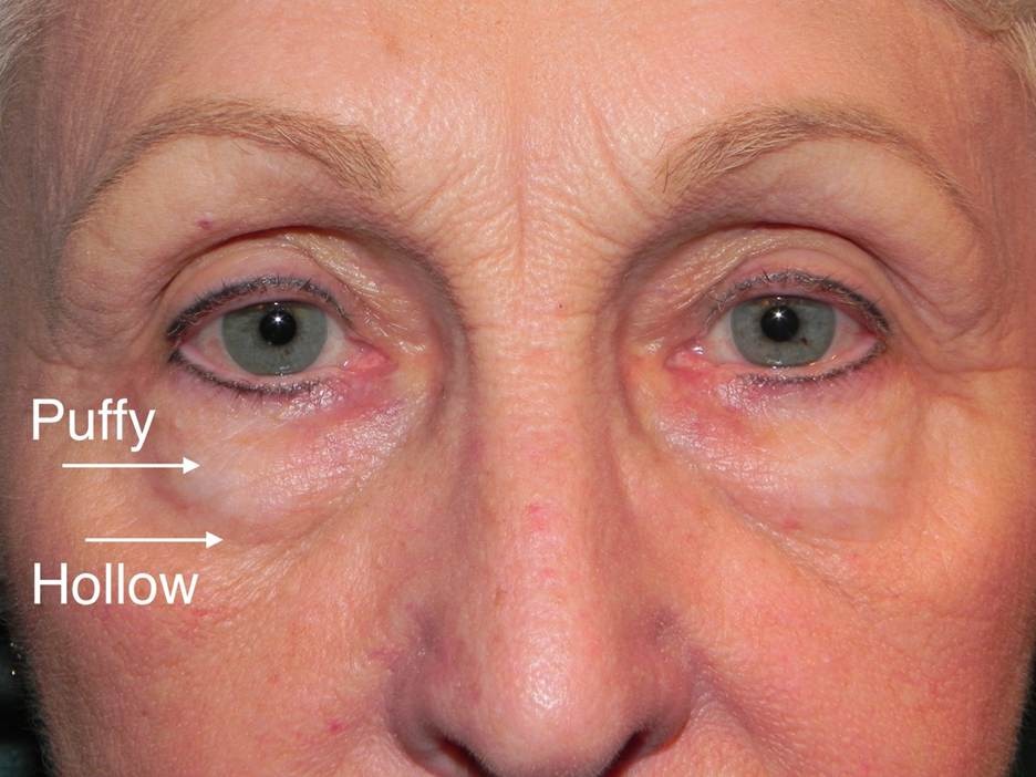 Hollow Eyes: Causes, Risks of Fillers, and the Best Fixes – Adam ...