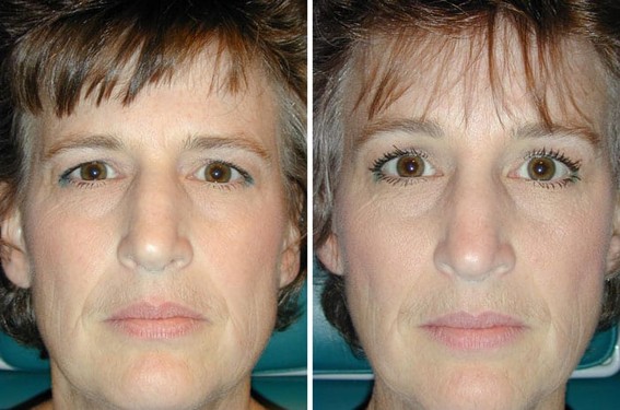 Photos-Minimal Incision Browlift – Adam Scheiner MD | Dr. Adam Scheiner
