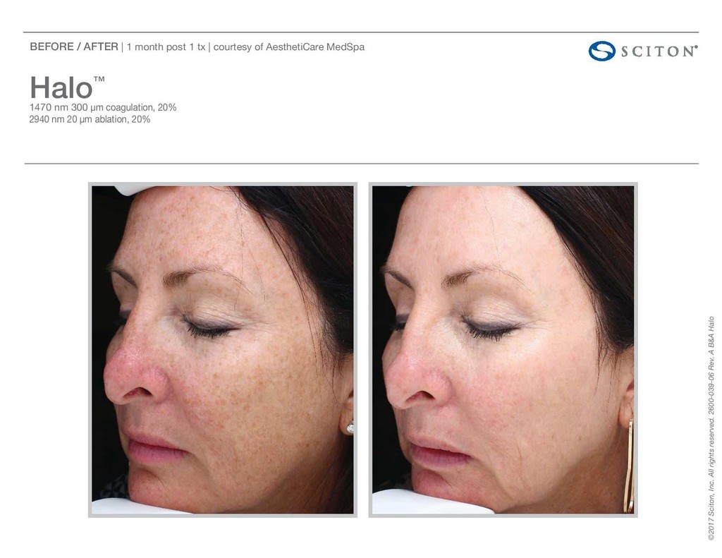 Can the HALO Laser Give You The Results You Want? – Adam Scheiner MD ...
