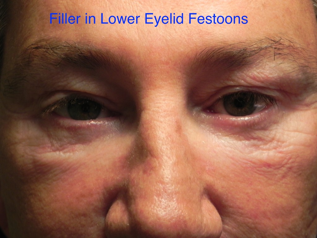 10 Things You NEED to Know About Festoons – Adam Scheiner MD | Dr. Adam ...