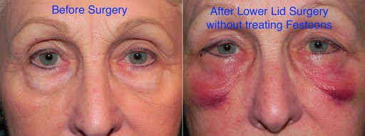 10 Things You NEED to Know About Festoons – Adam Scheiner MD | Dr. Adam ...