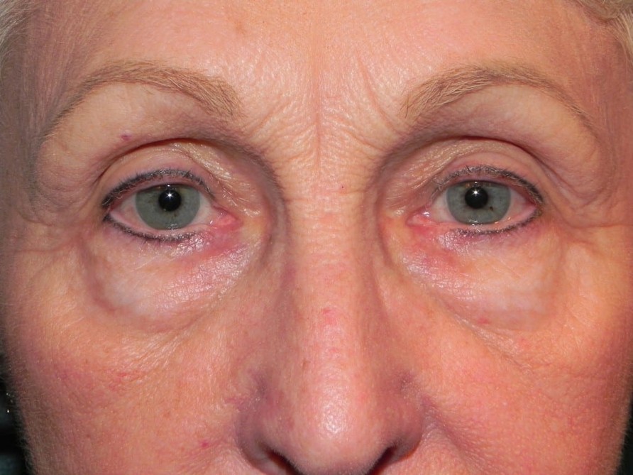 Lower Eyelid Bags vs. Festoons – Adam Scheiner MD | Dr. Adam Scheiner