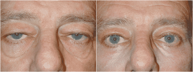 The Secret Role Festoons Play in Eyelid Rejuvenation – Adam Scheiner MD ...