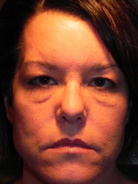 The Deeper Meaning Behind “Bitchy Resting Face” – Adam Scheiner MD | Dr ...