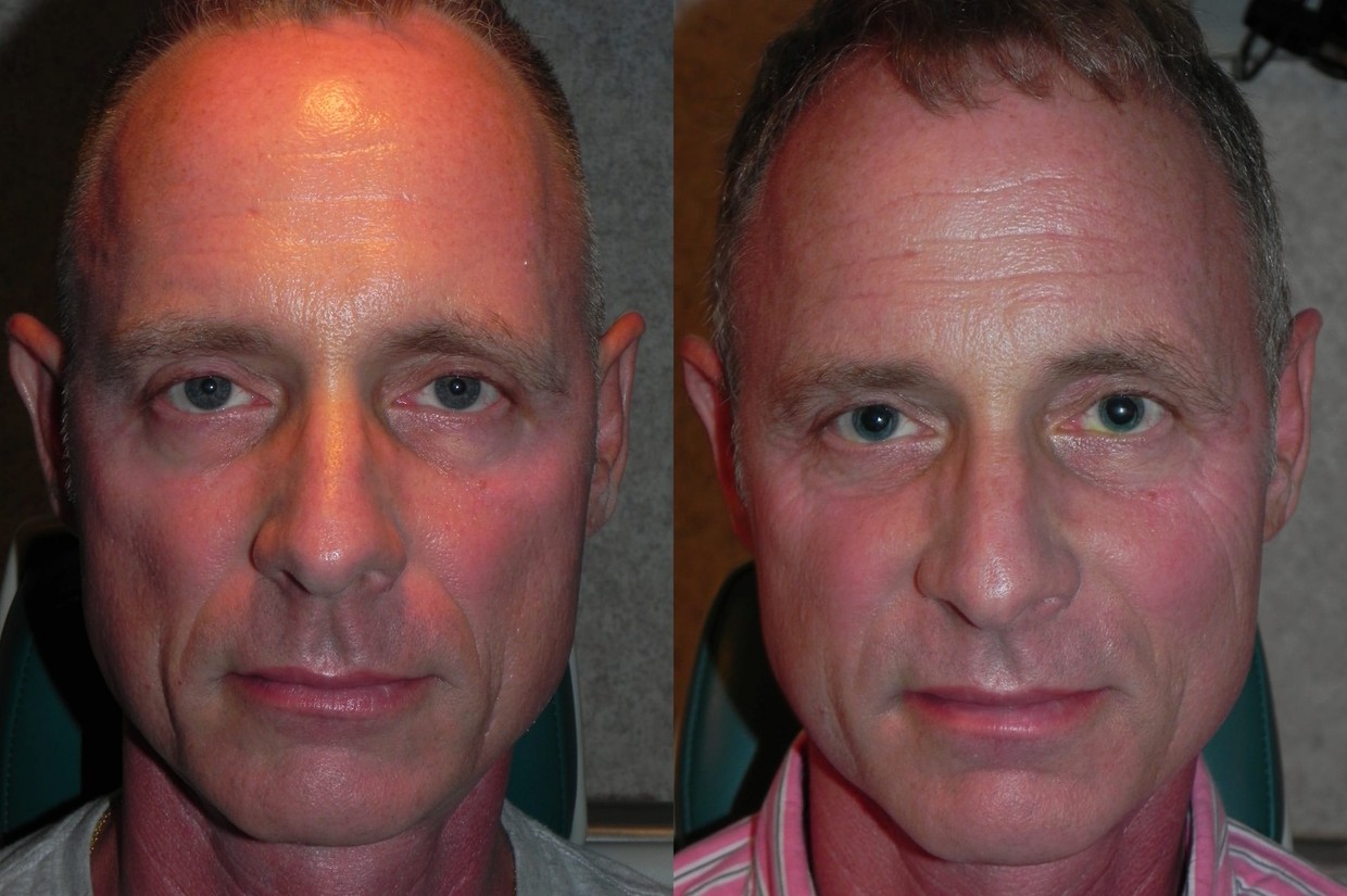 Lumps Common from Sculptra – Adam Scheiner MD | Dr. Adam Scheiner