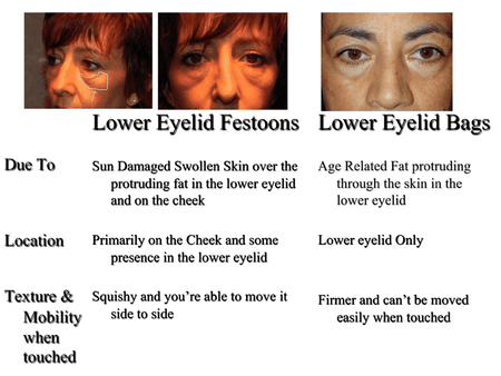 How to get rid of festoons under eyes – Adam Scheiner MD | Dr. Adam ...