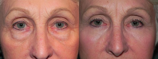 Festoons After Fillers – Adam Scheiner MD | Dr. Adam Scheiner