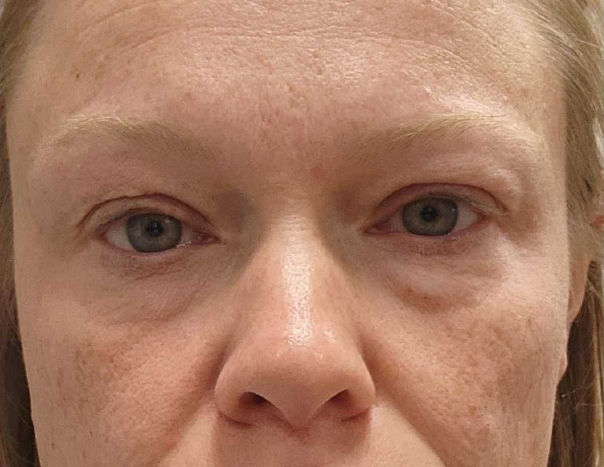 RESET® Upper Lids – Adam Scheiner MD | Dr. Adam Scheiner