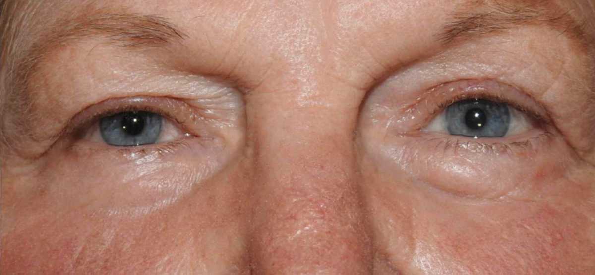 The Better Blepharoplasty – Adam Scheiner MD | Dr. Adam Scheiner