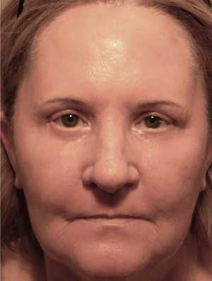 RESET® Full Face – Adam Scheiner MD | Dr. Adam Scheiner