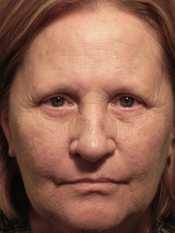 Adam Scheiner MD – Laser Eyelid & Facial Plastic Surgery | Dr. Adam ...