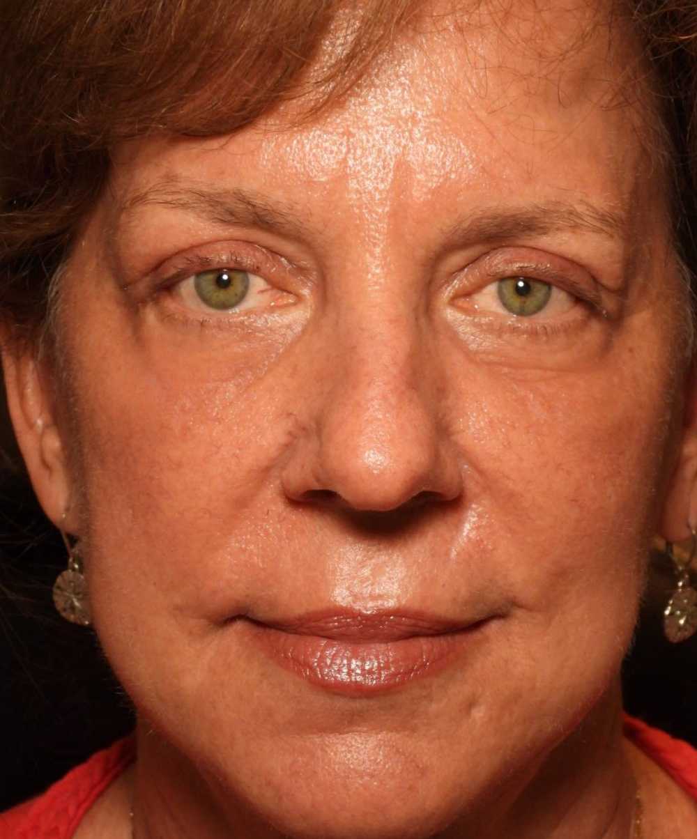 Before & After Gallery – Adam Scheiner MD – Laser Eyelid & Facial ...