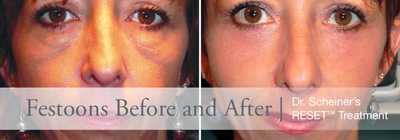 Festoons Before and After Dr. Scheiner's Treatment – Adam Scheiner MD ...