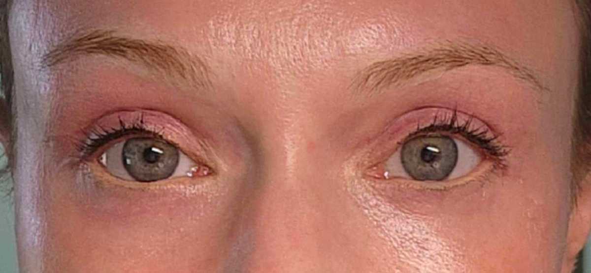 The Better Blepharoplasty – Adam Scheiner MD | Dr. Adam Scheiner