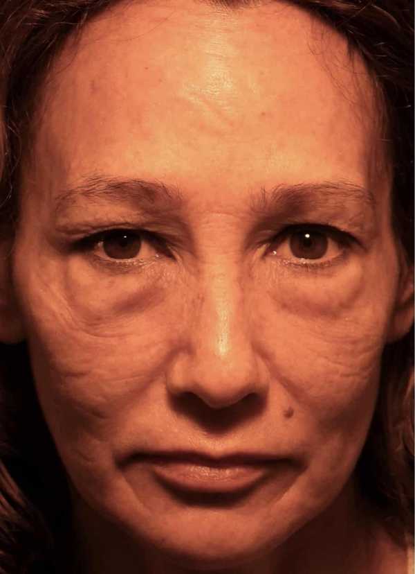 Adam Scheiner MD – Laser Eyelid & Facial Plastic Surgery | Dr. Adam ...